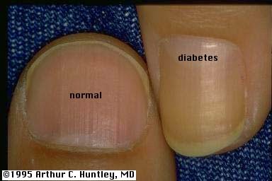 d ). Cuticle becomes ragged in dermatomyositis.