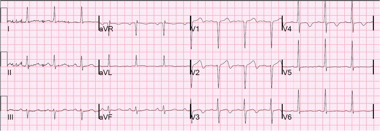 Dr. Smith's ECG Blog: Reversible T-wave inversion -- it reverses, then ...