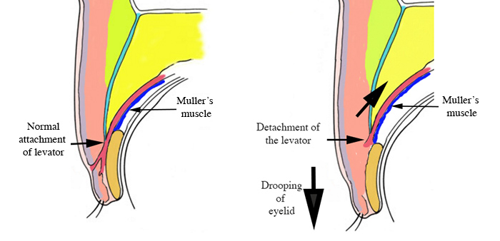 Eyelid Surgery by Prof Dr CN CHUA 蔡鐘能: Doc, Could You Balance My Eyes ...