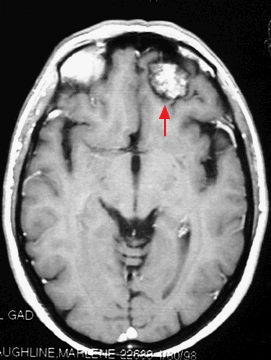 Case of the Day: Popcorn