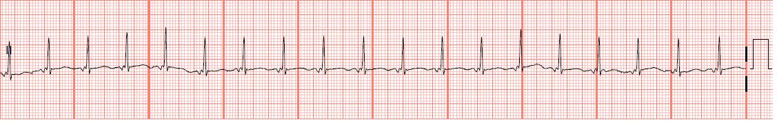 EKG Rhythm Strips 33