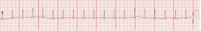 EKG Rhythm Strips 33