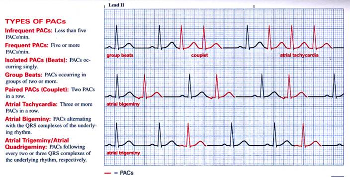 Premature Atrial Contraction (PAC) - JANTUNG OKE