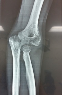 O R T O C R I T I C A: Luxaccion Inveterada de codo izquierdo