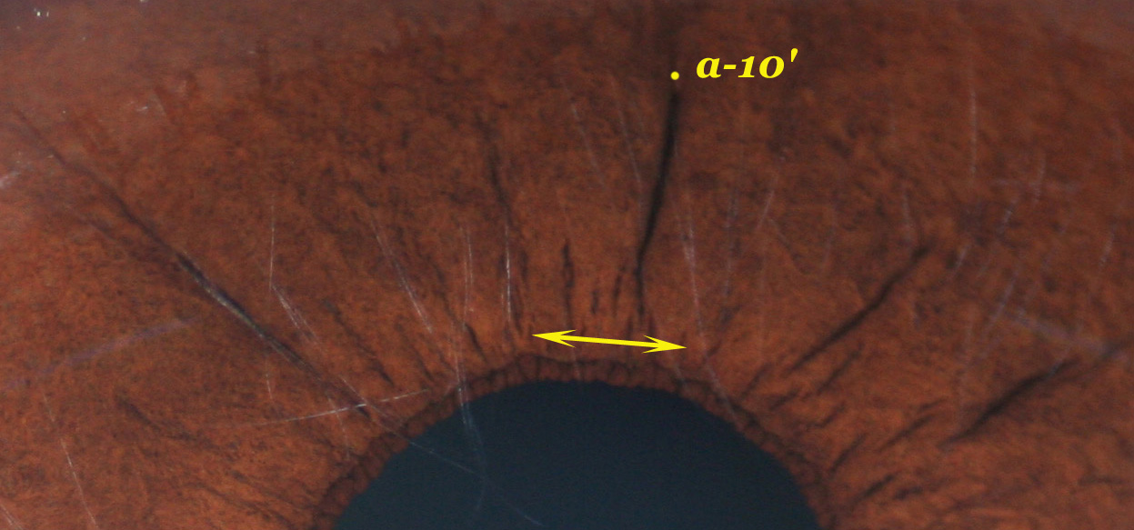 Modern & Multidimensional Iridology: Pupil Flatness, Mammilations ...