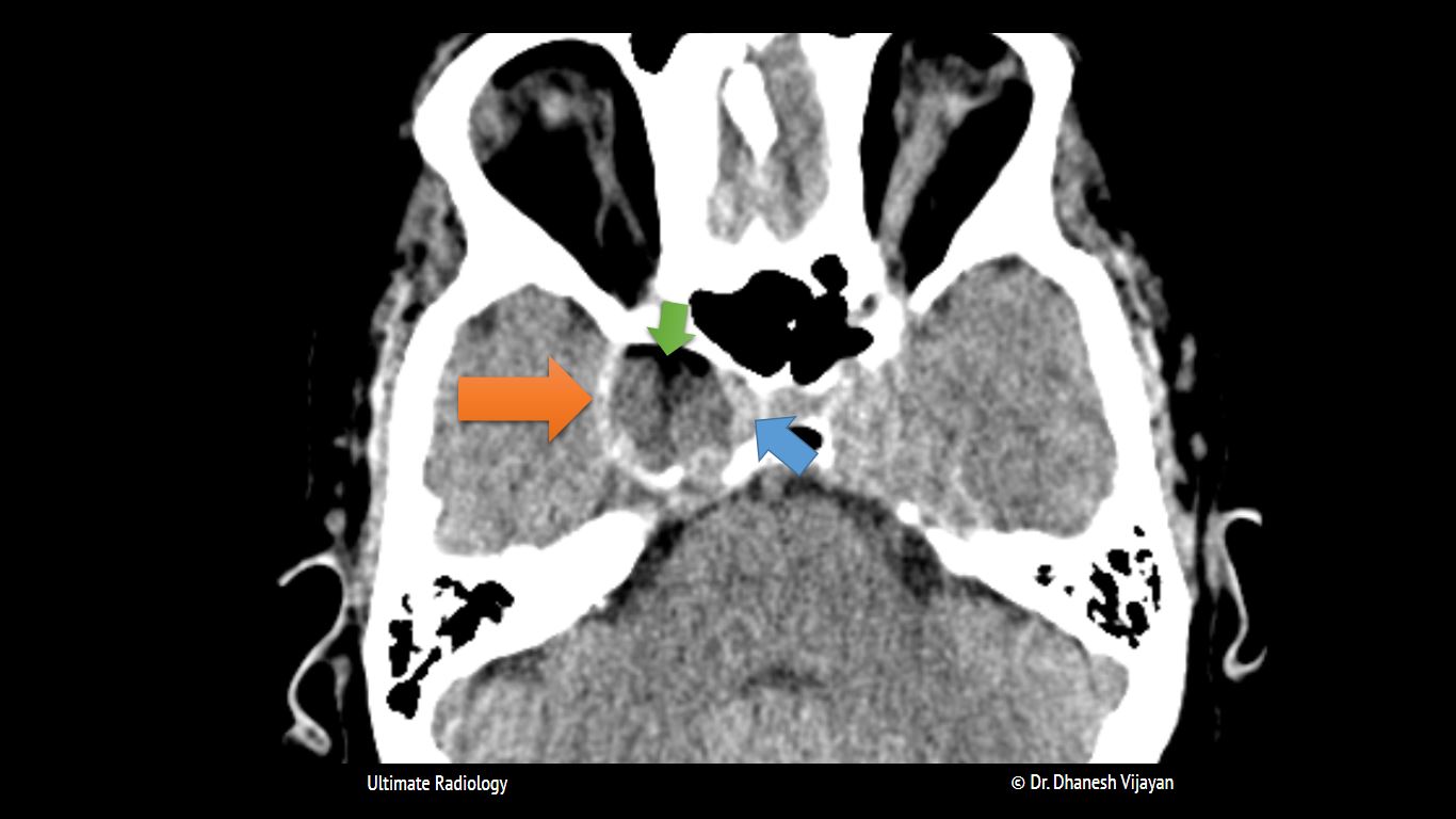 Ultimate Radiology : Cavernous Sinus Dermoid Cyst