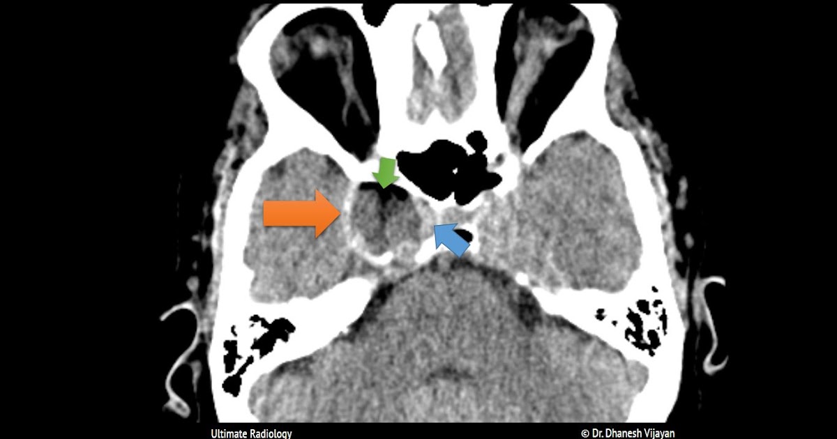 Ultimate Radiology : Cavernous Sinus Dermoid Cyst