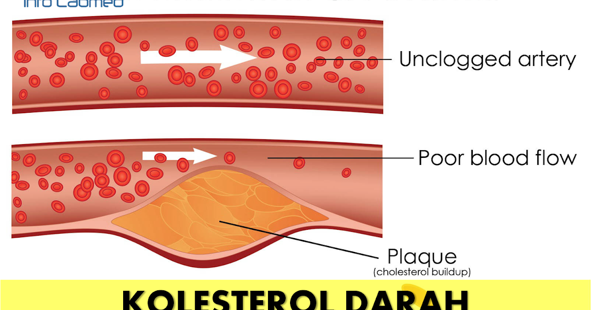 Kolesterol | Pemahaman dan Penyebab Meningkatnya Kadar Kolesterol Dalam ...
