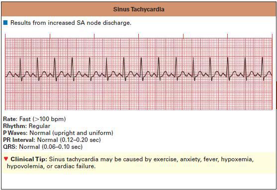 Tachycardia, Sinus; Sinus Tachycardia