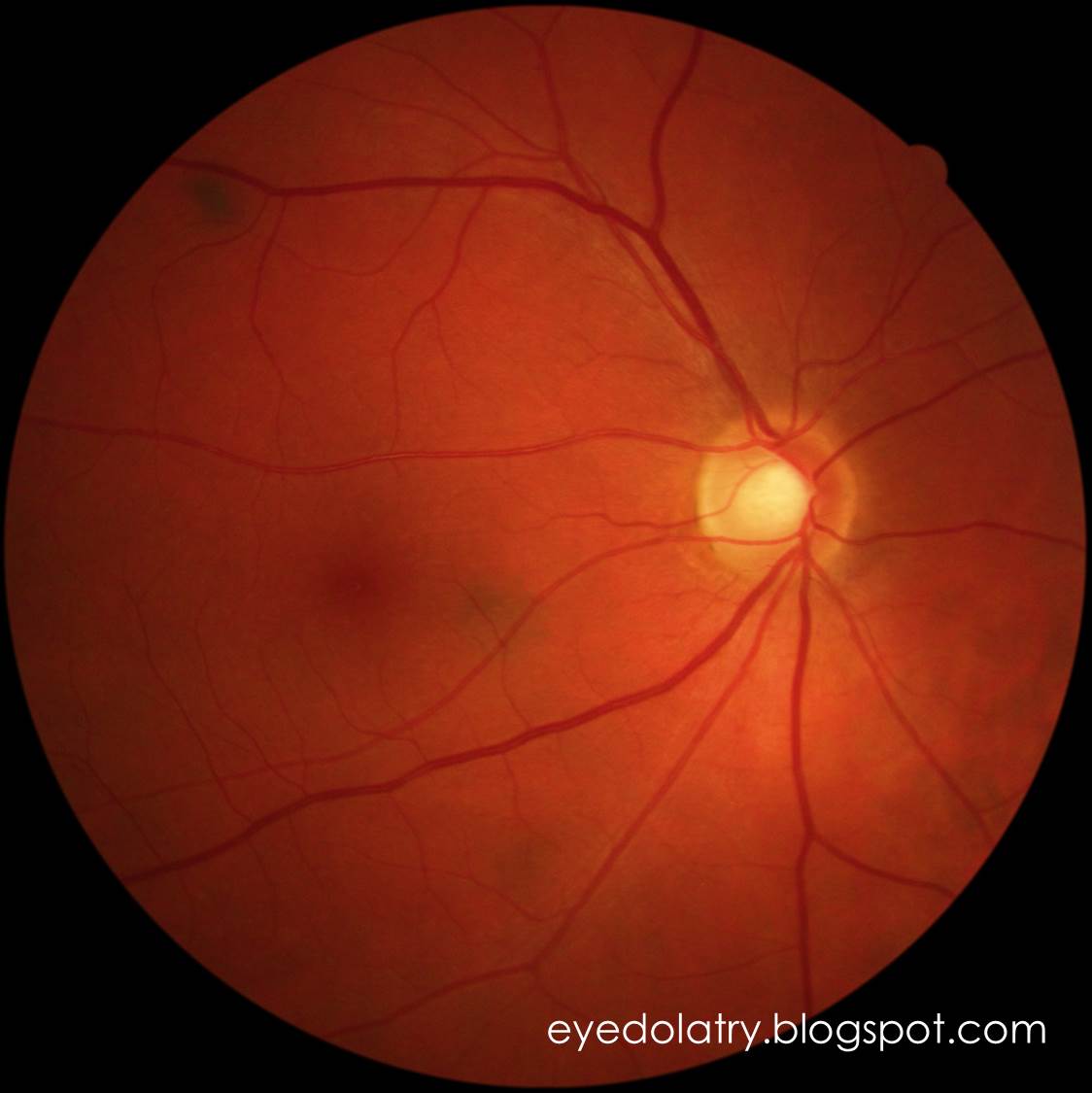 Diagnose My Retinal Photograph: Freckles Inside the Eye - Eyedolatry