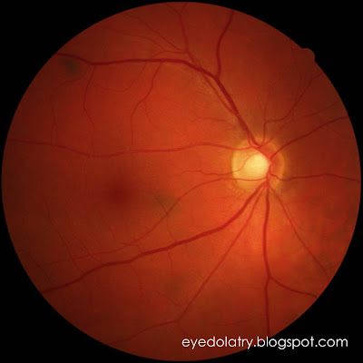 Diagnose My Retinal Photograph: Freckles Inside the Eye - Eyedolatry