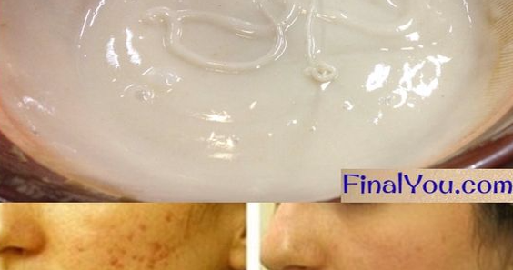 UNBELIEVABLE!! HOMEMADE FACE MASK TO GET RID OF SPOTS, ACNE SCARS, AND ...