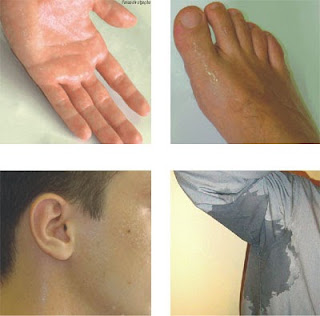 Consultoria de Enfermagem Mendes & Hernandez: Sudorese - Hiper hidrose ...