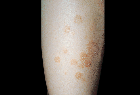 Vivir Mejor: ¡Atención! El eccema numular si tiene cura