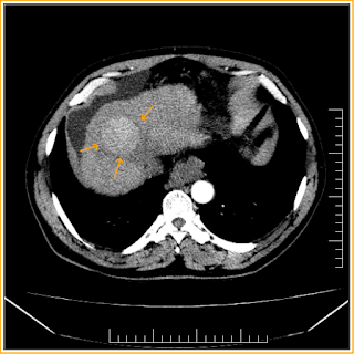 Hepatocellular carcinoma-CT - Sumer's Radiology Blog