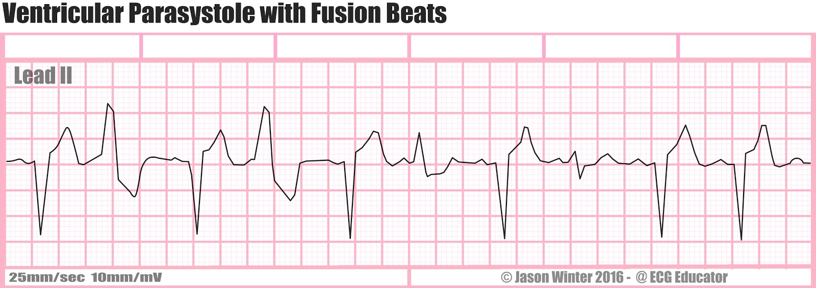 ECG Educator Blog : Six Second ECG Rhythm Strips