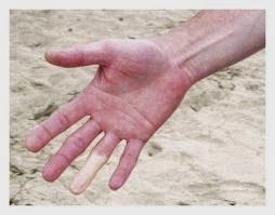 The Osteopathic Centre: White finger syndrome