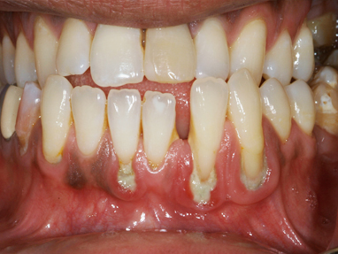 Deformutilation: Receding Gums
