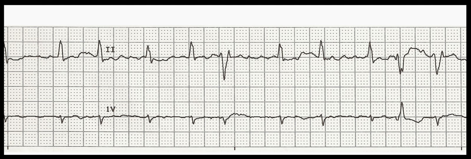 EKG Rhythm Strip Quiz 182
