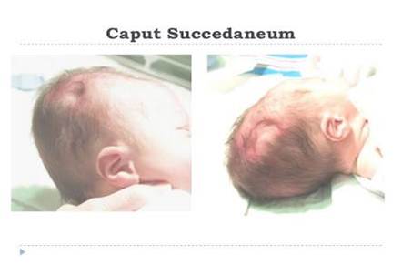 sri raningsih: Caput succedaneum dan Cephalhematoma
