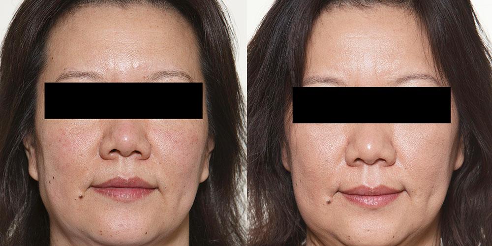 Silk'n ReVit Diamond-Peeling Microderm Device: 2015