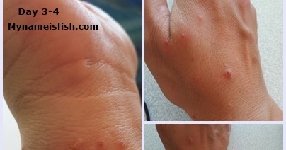 Stages of Poison Ivy Rash and Blisters