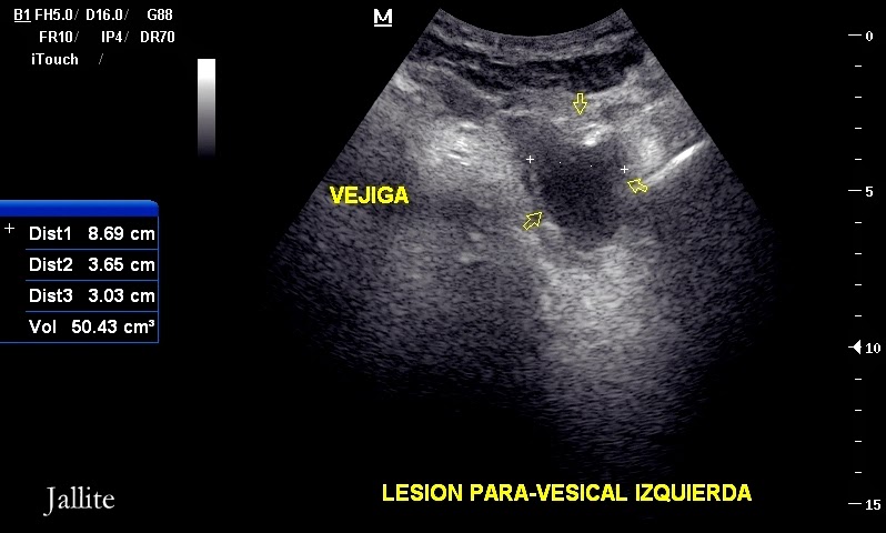 Absceso Pelvico en Hombre