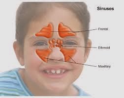 Gejala Sinusitis pada Anak