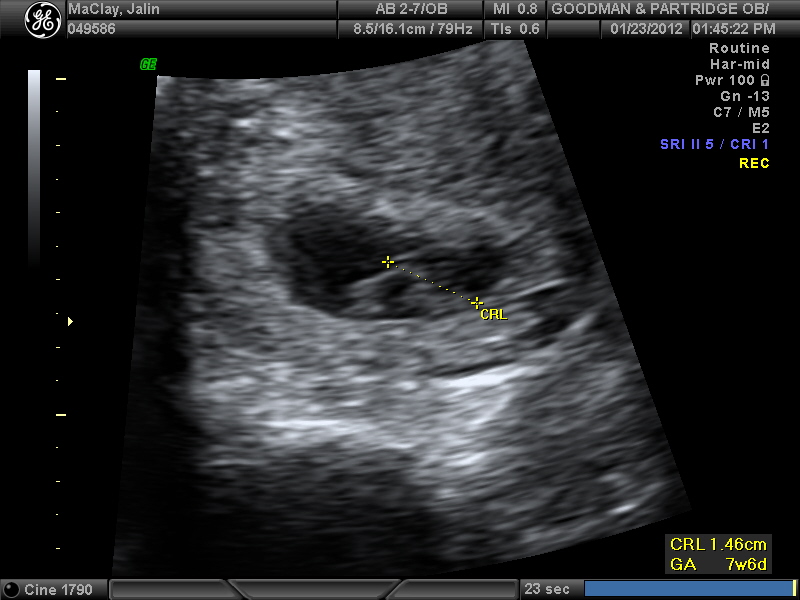 The Merrell Family: 7 weeks and 5 days Ultrasound Pictures