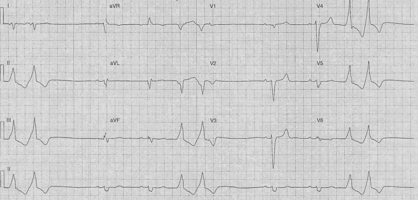 ECG of the Week: ECG of the Week - 6th May 2013