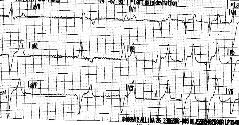 Dr. Smith's ECG Blog: ST Elevation and a Wide QRS. EMS activates the ...