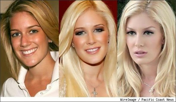 Heidi Montag Plastic Surgery Before And After Breast Implants Pictures
