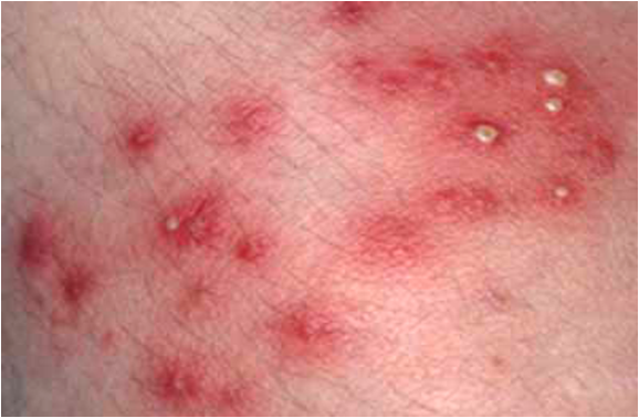 Staph / impetigo : r/eczema