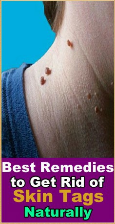 Best Remedies to Get Rid of Skin Tags Naturally - beauty4everything