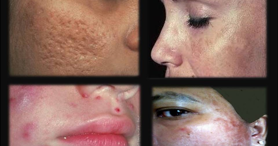 Qisas: Jenis masalah kulit muka