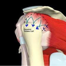 Medical Treatment Pictures-for Better Understanding: Shoulder Surgery ...