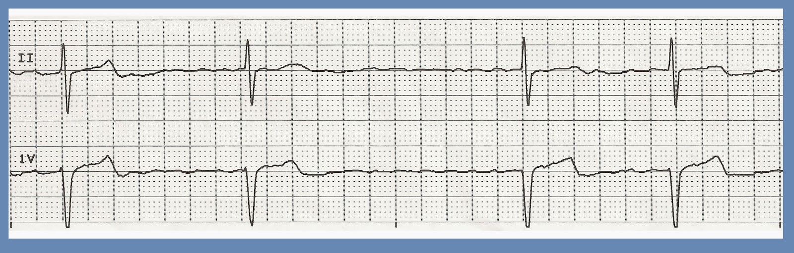 EKG Rhythm Strip Quiz 202
