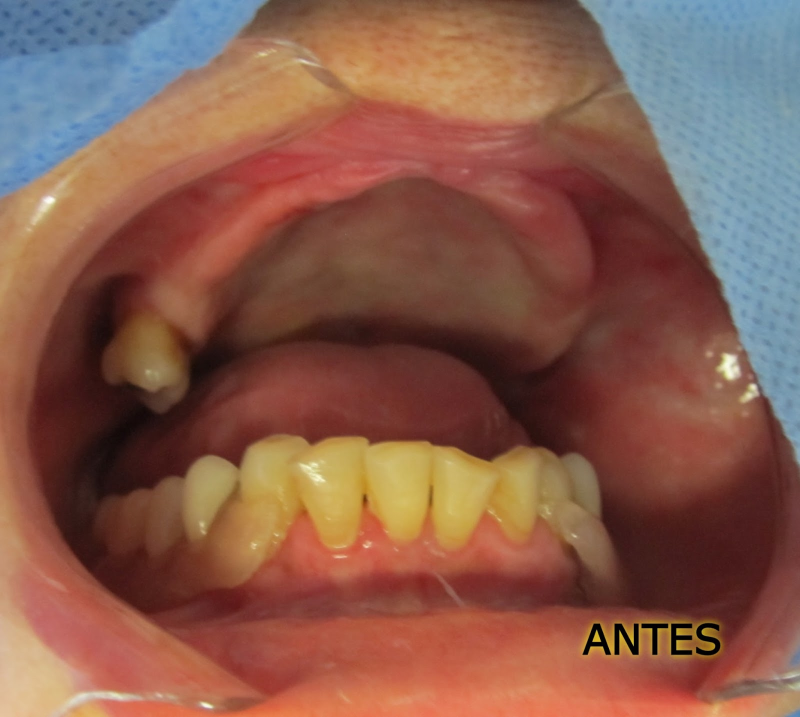 Odontología Estética Integrada Odontesin: Caso clínico: Prótesis Total ...