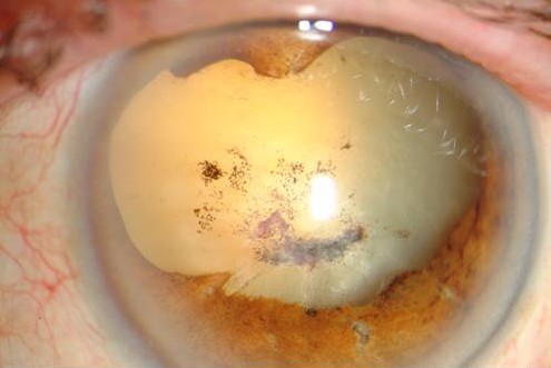 Deformutilation: Cataracts