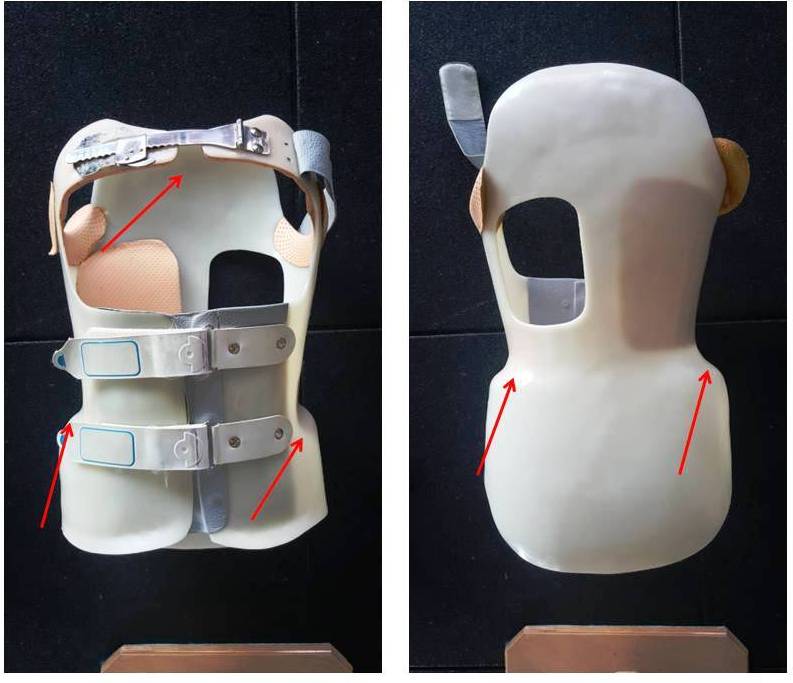 Despre corsetul Cheneau :: Corset scolioza / scoliosis braces