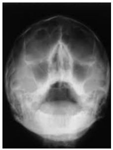 Cara (orbitas, huesos propios de la nariz (HPN), senos paranasales (SPN ...