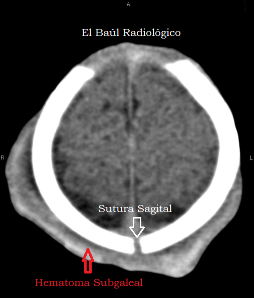 El Baúl Radiológico: 2) HEMATOMA SUBGALEAL: HALLAZGOS EN TOMOGRAFÍA ...
