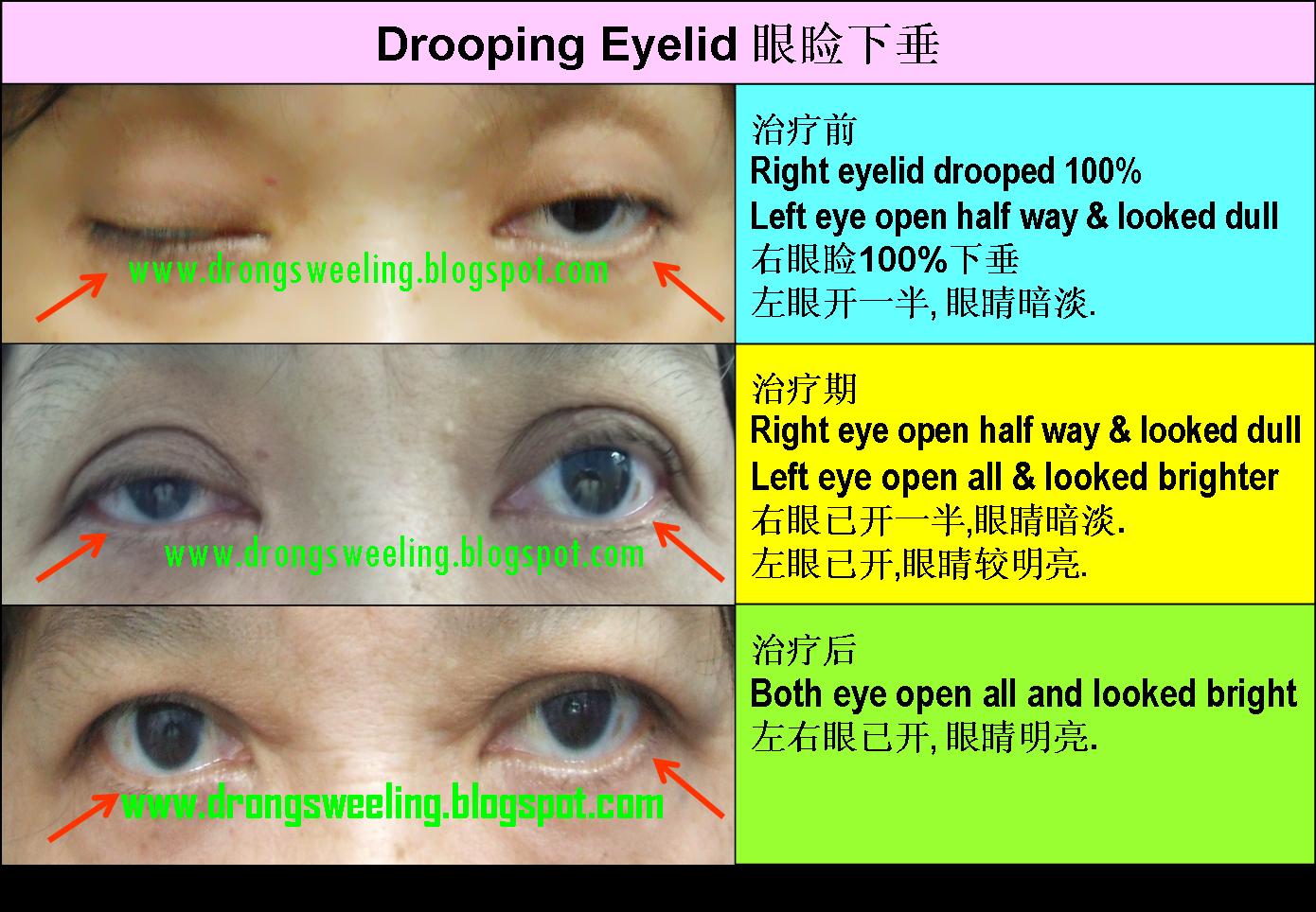 TCM News: Acupuncture Cure Drooping Eyelids 眼睑下垂