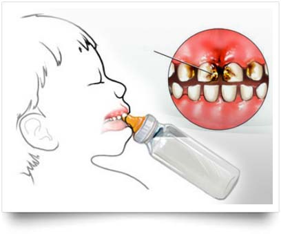 XTO 3D: CARIES RAMPANTE O ENFERMEDAD DEL BIBERON