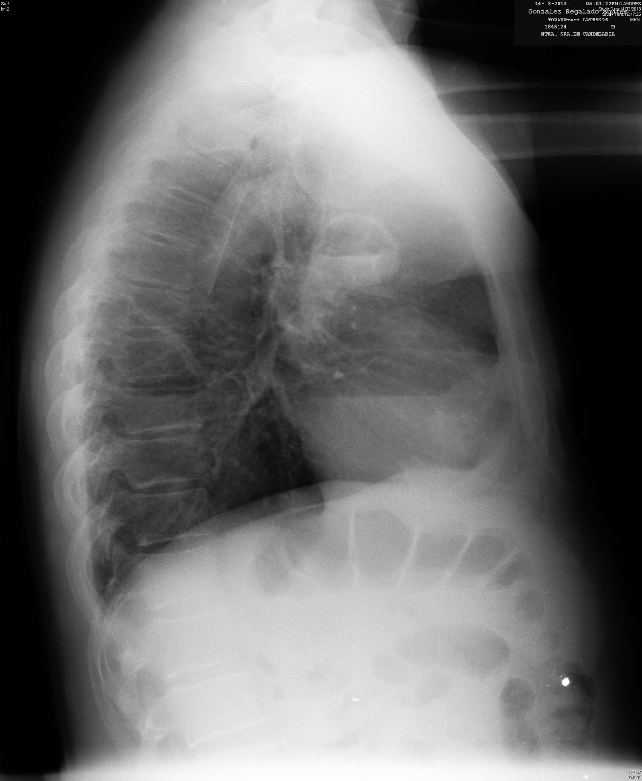 ZONA DE SALUD DE OFRA: ABSCESO PULMONAR, IMAGEN RX