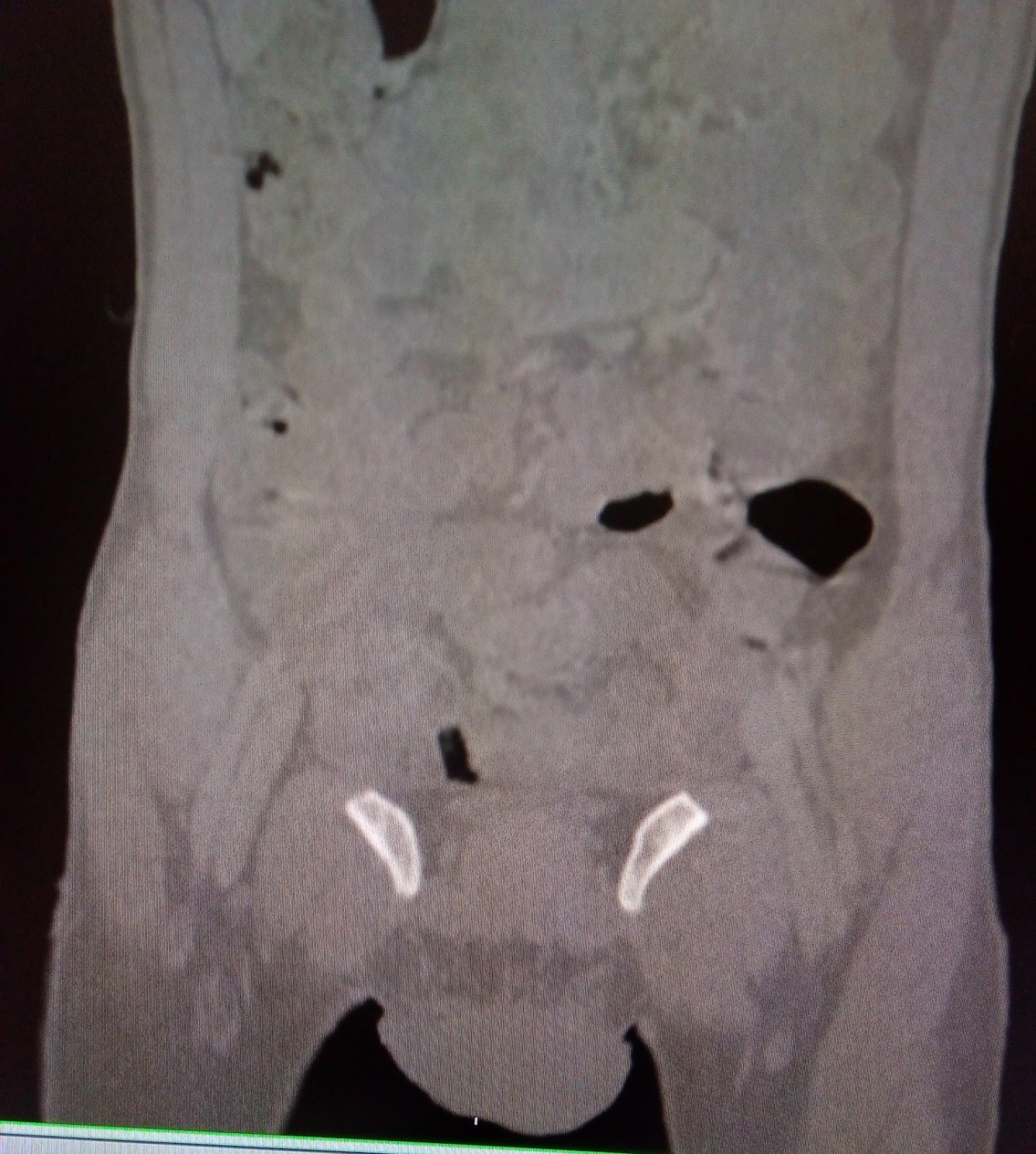 Bladder exstrophy – CT - Sumer's Radiology Blog