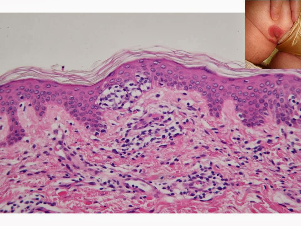 Pautrier Microabscesses Mycosis Fungoides