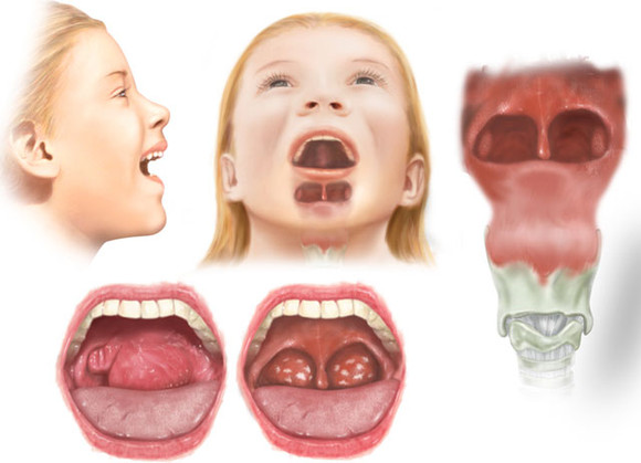 Amigdalite: Amigdalite - O que é