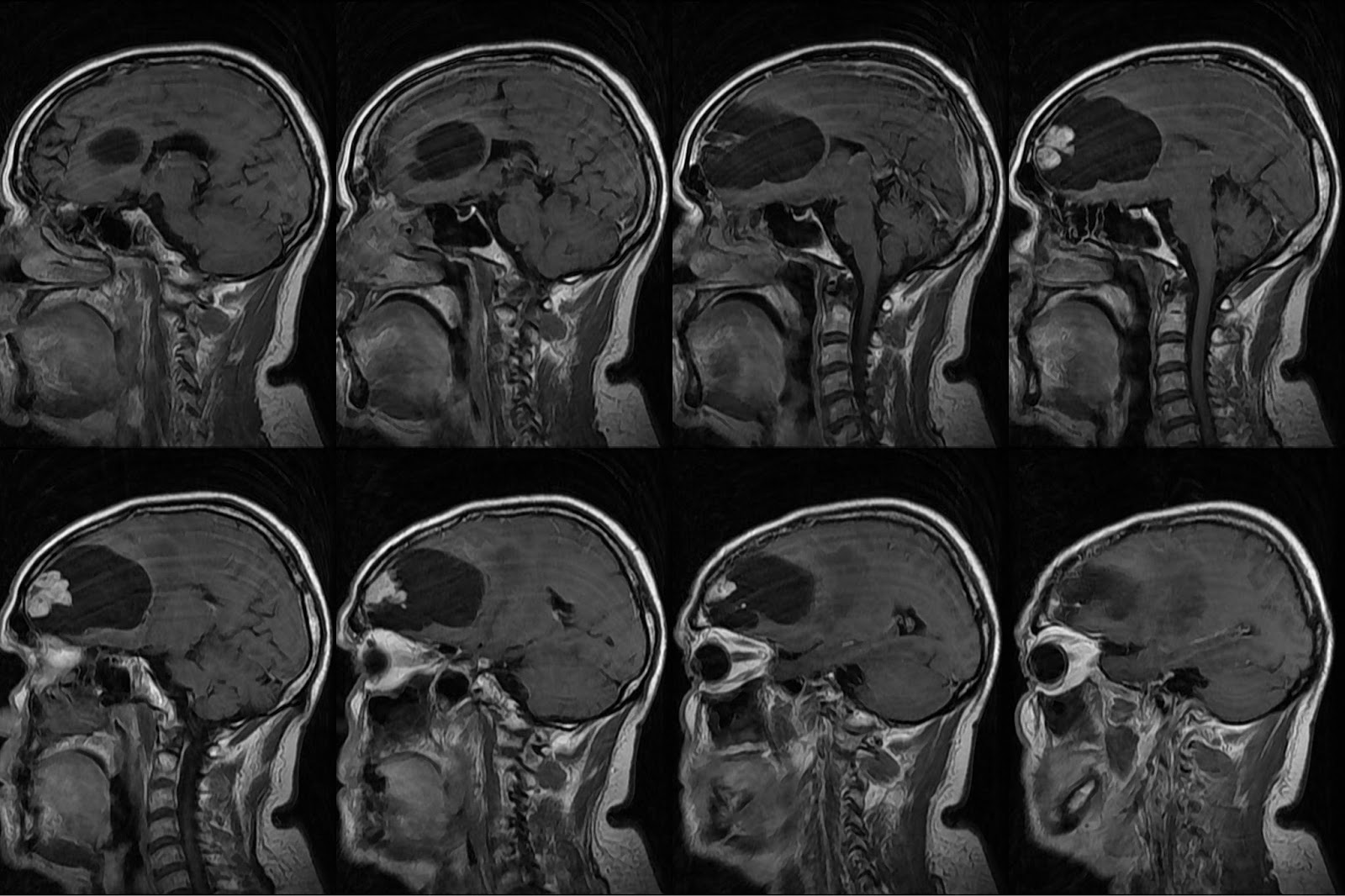 Dr Balaji Anvekar FRCR: Frontal SOL, Guess Histopathology