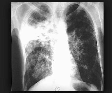 Tuberkulosis (TB) Paru pada Orang Dewasa